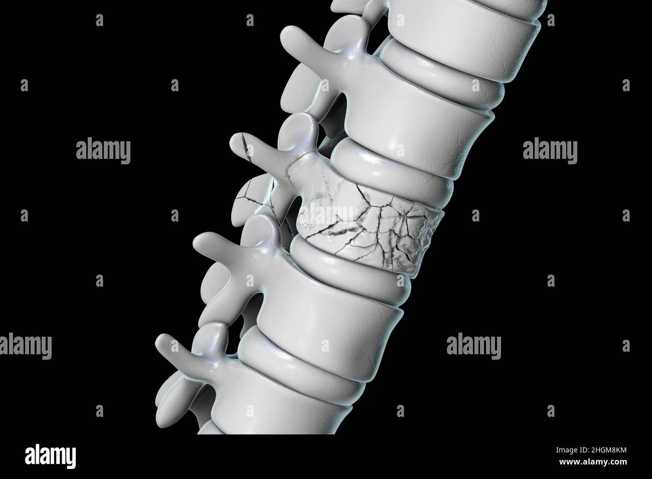 Fracture de la colonne vertébrale, illustration Photo Stock - Alamy