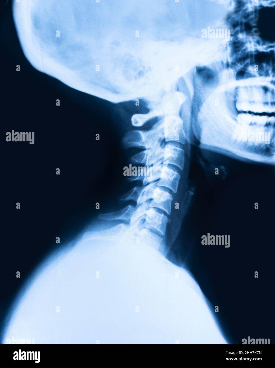 Imagerie par rayons X du rachis cervical.IRM des disques vertébraux ...