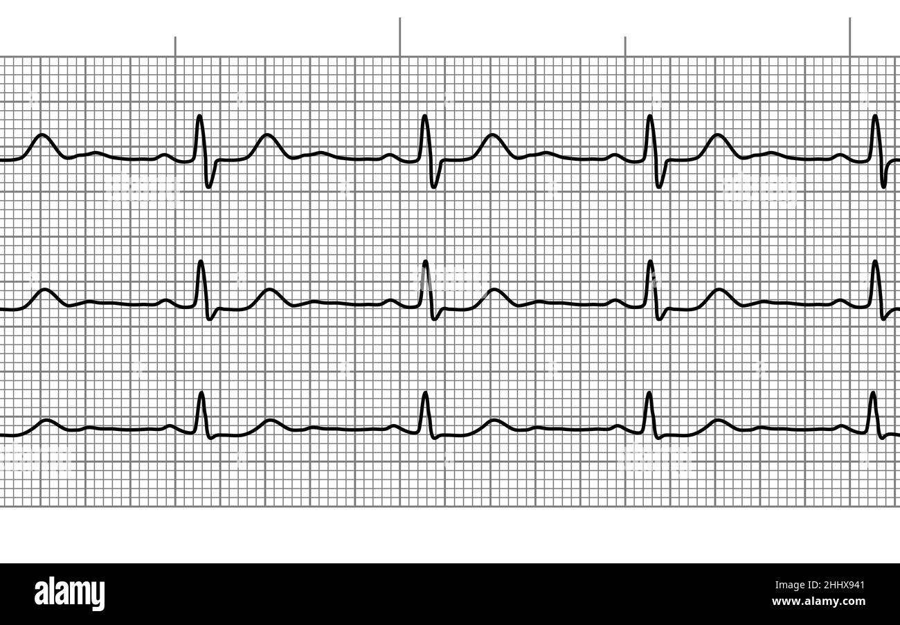 ecg de battements cardiaques ou ligne ekg transparente sur papier noir ...