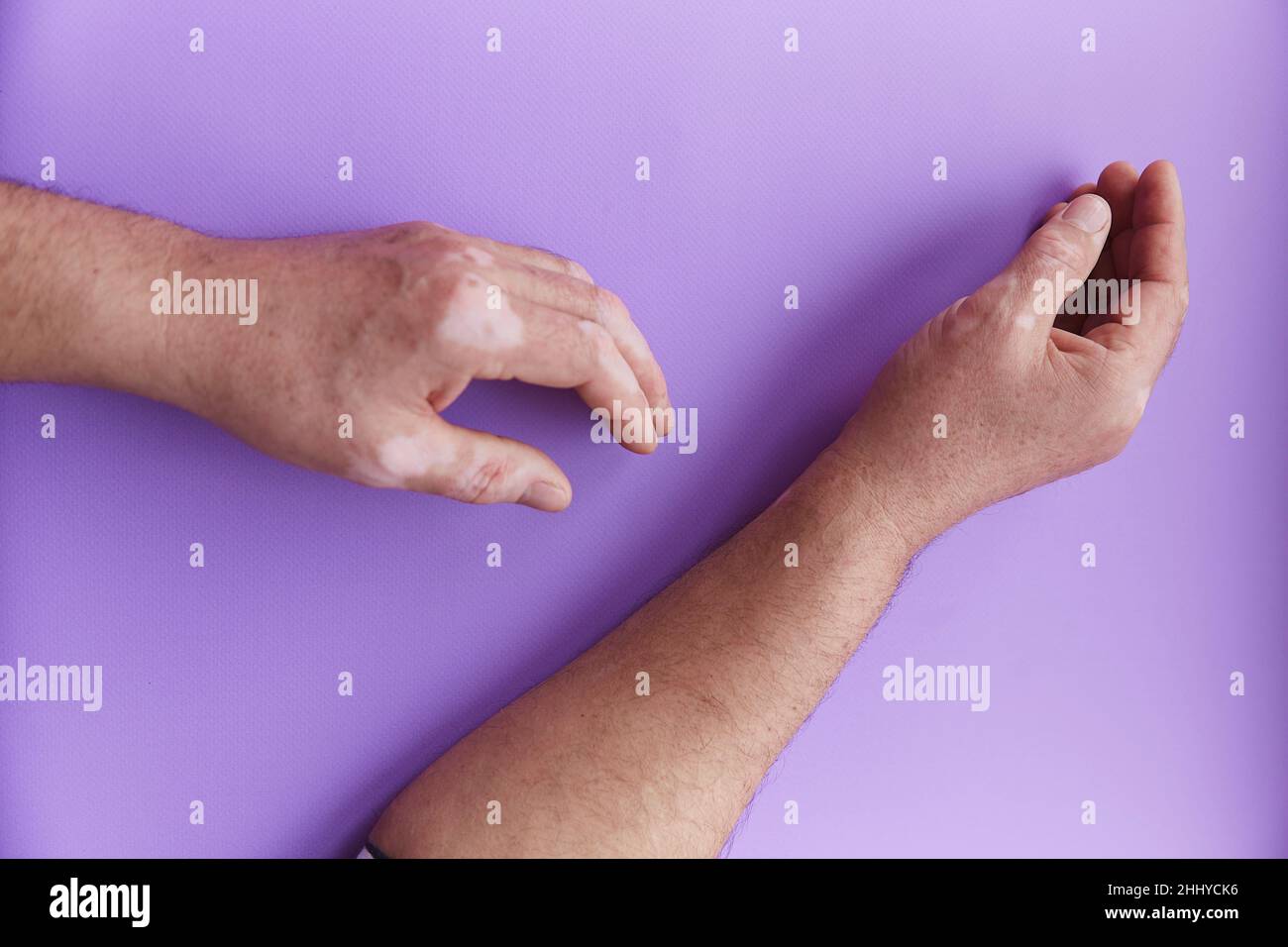 Pigmentation peau Banque de photographies et d’images à haute ...