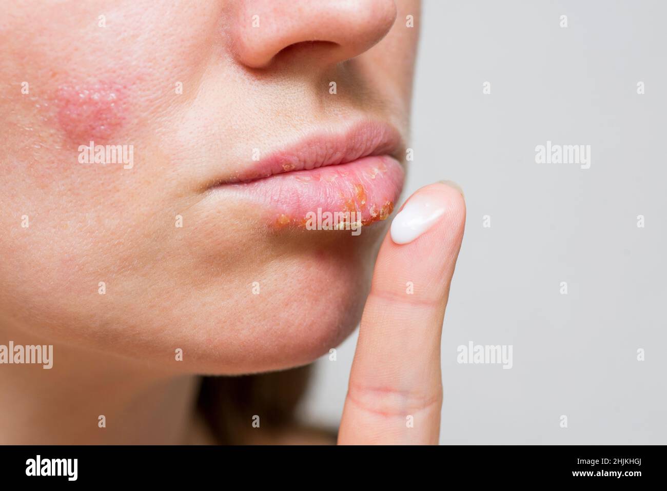 Elle sent ses plaies sur les lèvres avec un onguent de l'infection à l ...