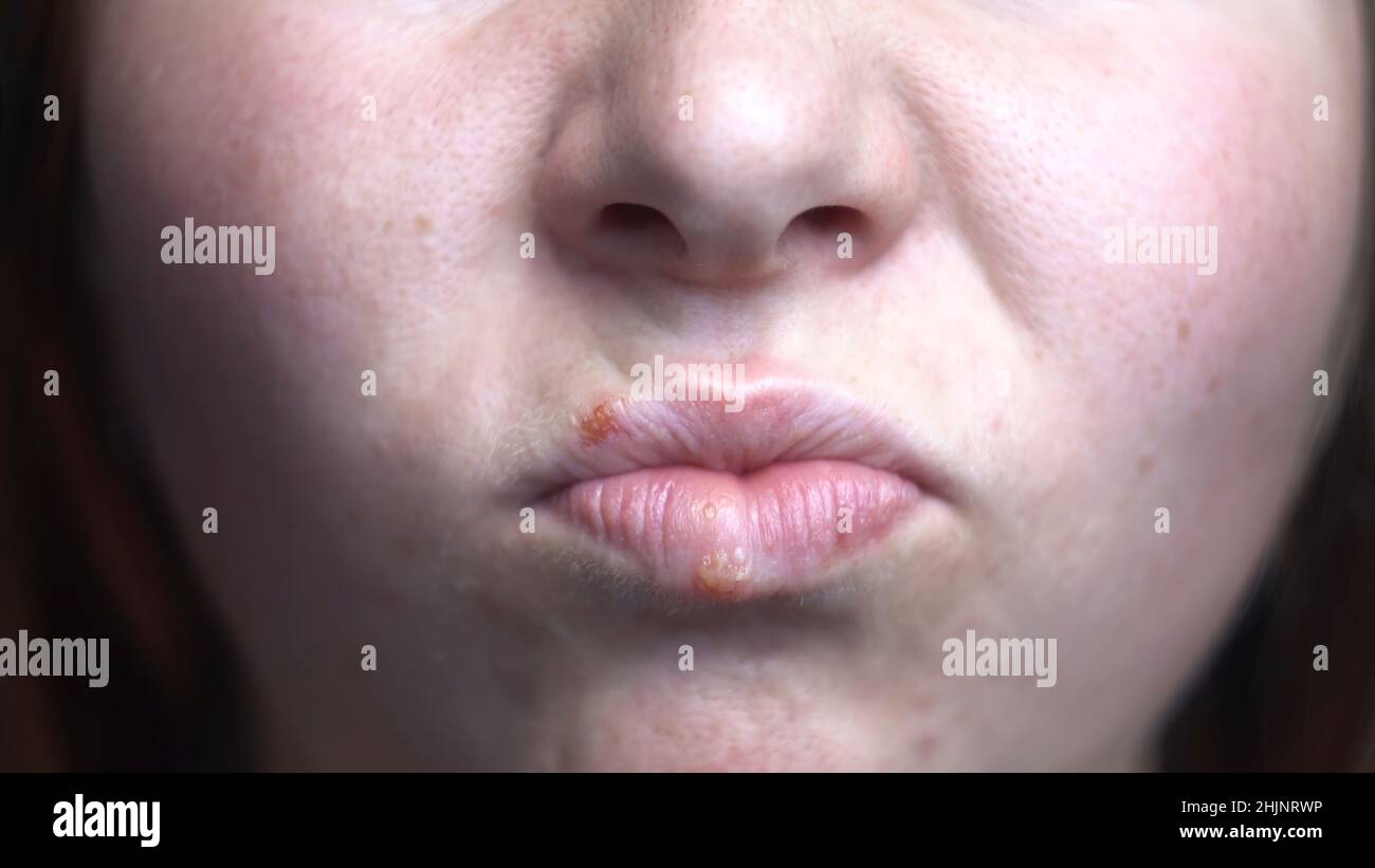 Gros plan de la maladie de l'herpès sur les lèvres d'une jeune fille ...