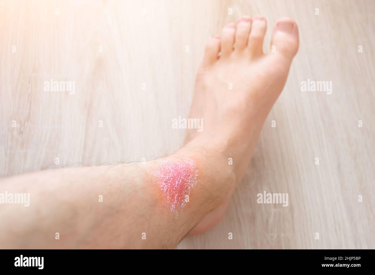 Tache rouge peau sur la jambe Banque de photographies et d’images à ...