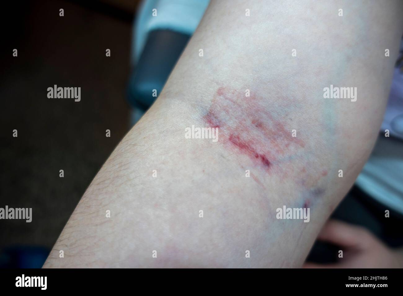 Skin irritation Banque de photographies et d’images à haute résolution ...