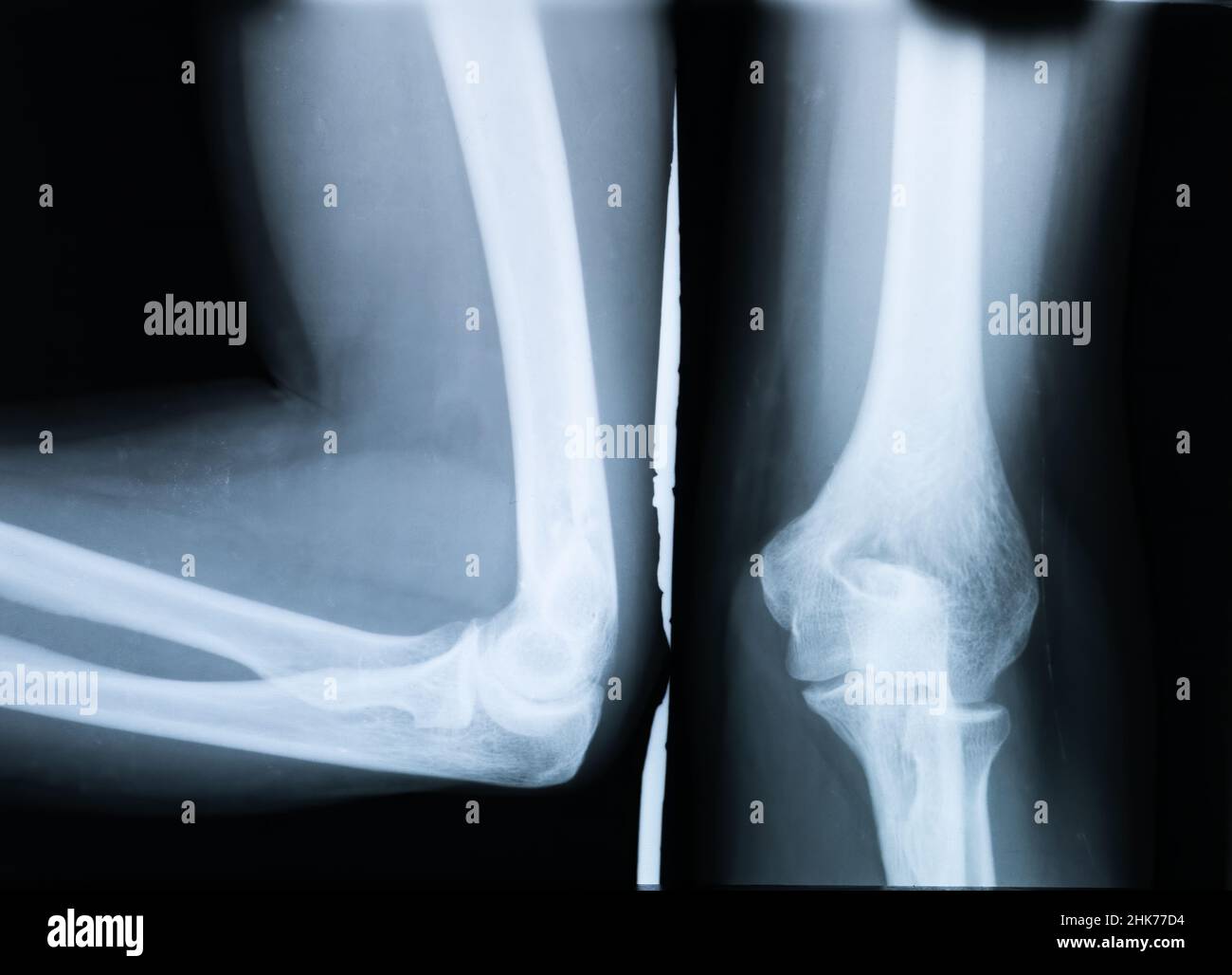 Fracture de la rotule Banque de photographies et d’images à haute ...