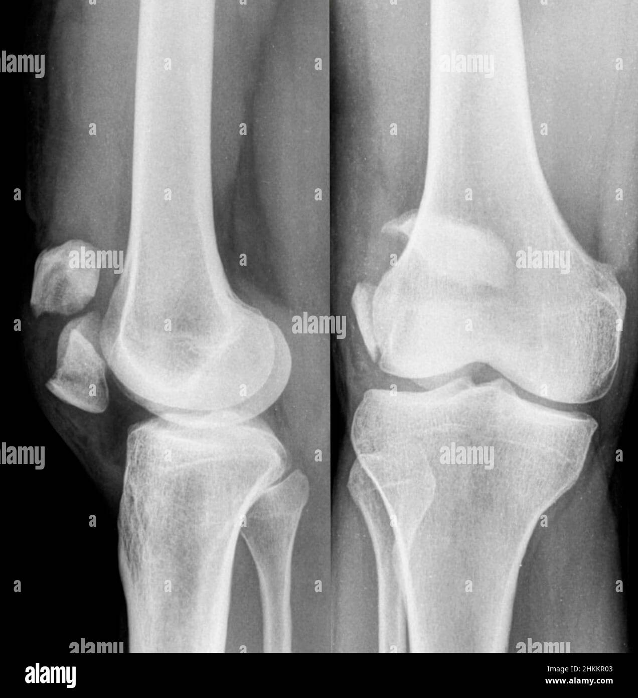 Patellar fracture Banque de photographies et d’images à haute ...
