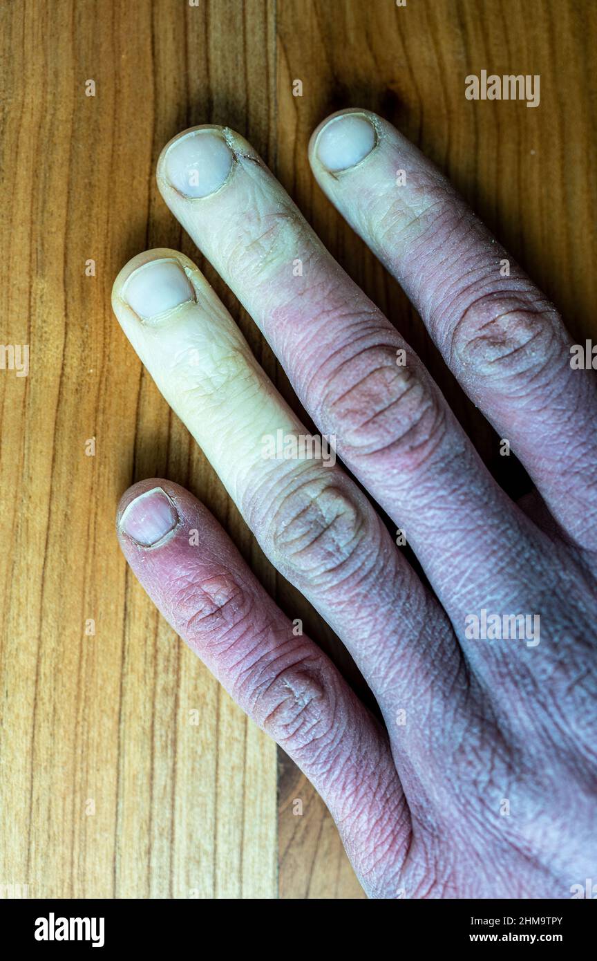 Une main masculine frostbitten avec le syndrome de Raynaud, le ...