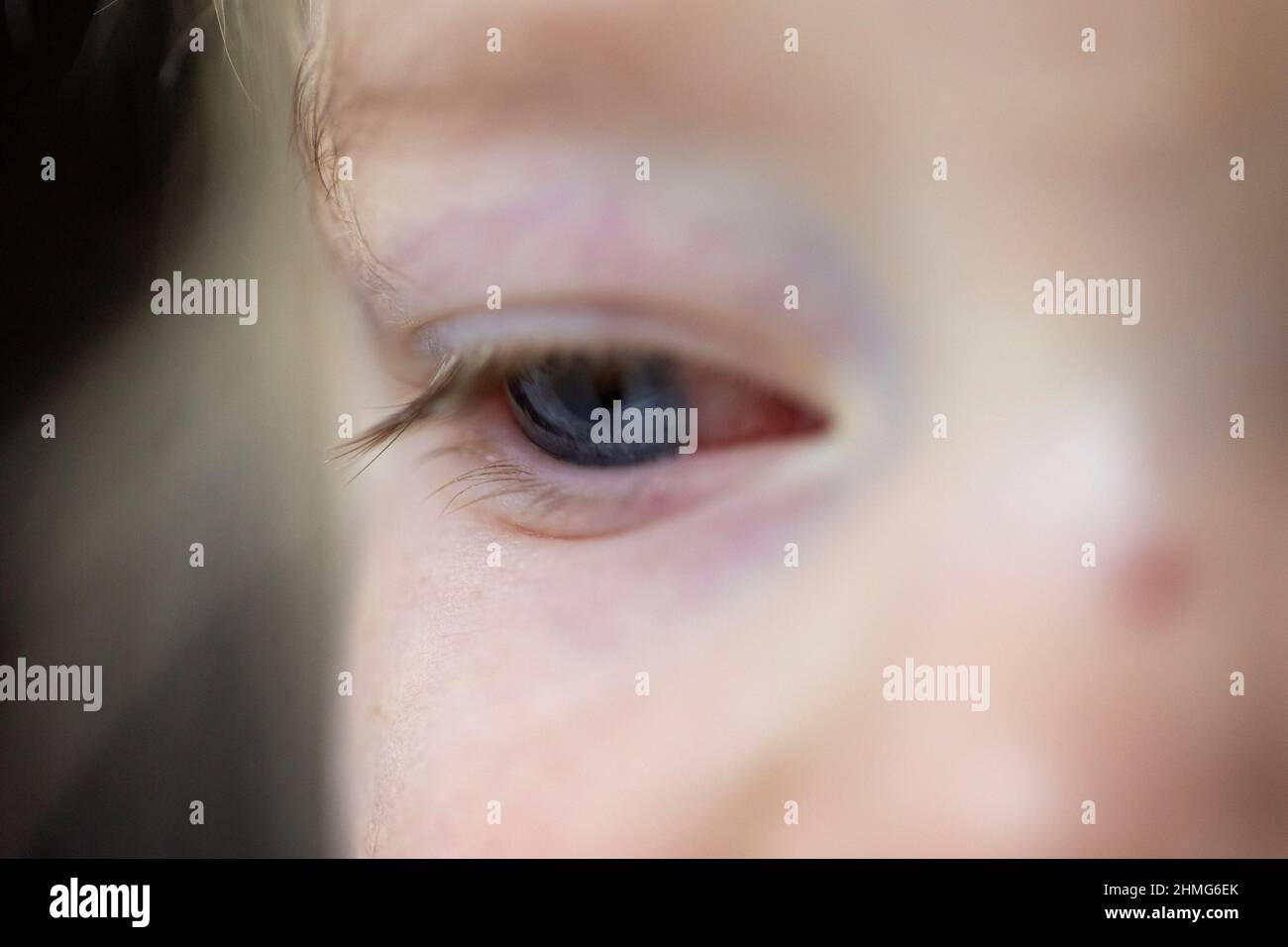 Un œil rouge infecté à moitié ouvert d'un enfant avec conjonctivite. Le ...