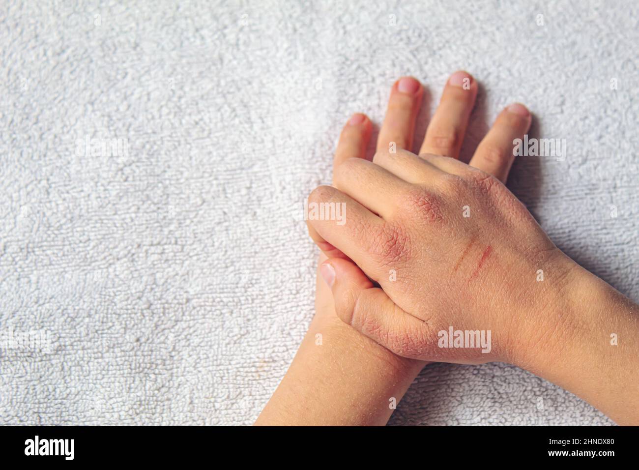 Skin rash eczema on hands Banque de photographies et d’images à haute ...