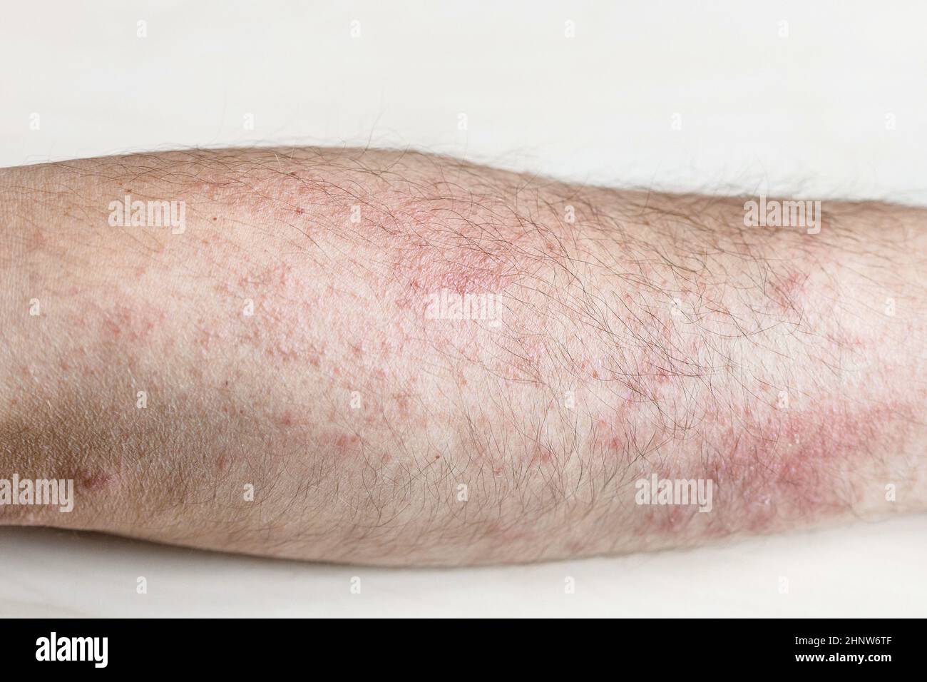 Inflamed dermatitis Banque de photographies et d’images à haute ...