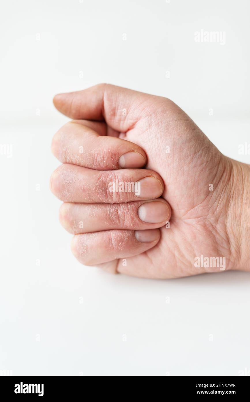 Traitement des maladies de la peau.Psoriasis, eczéma, dermatite ...