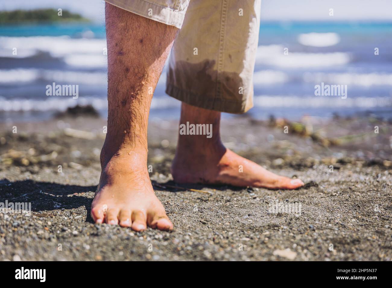 Maladie de peau sur les jambes Banque de photographies et d’images à ...