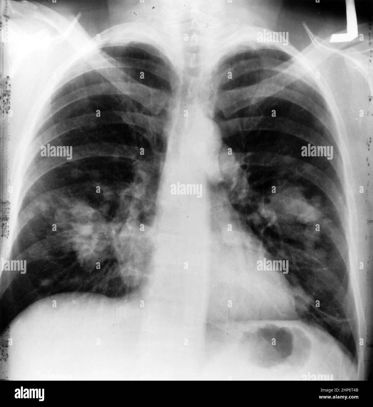 Radiografia de cancer de pulmon Banque d'images noir et blanc - Alamy