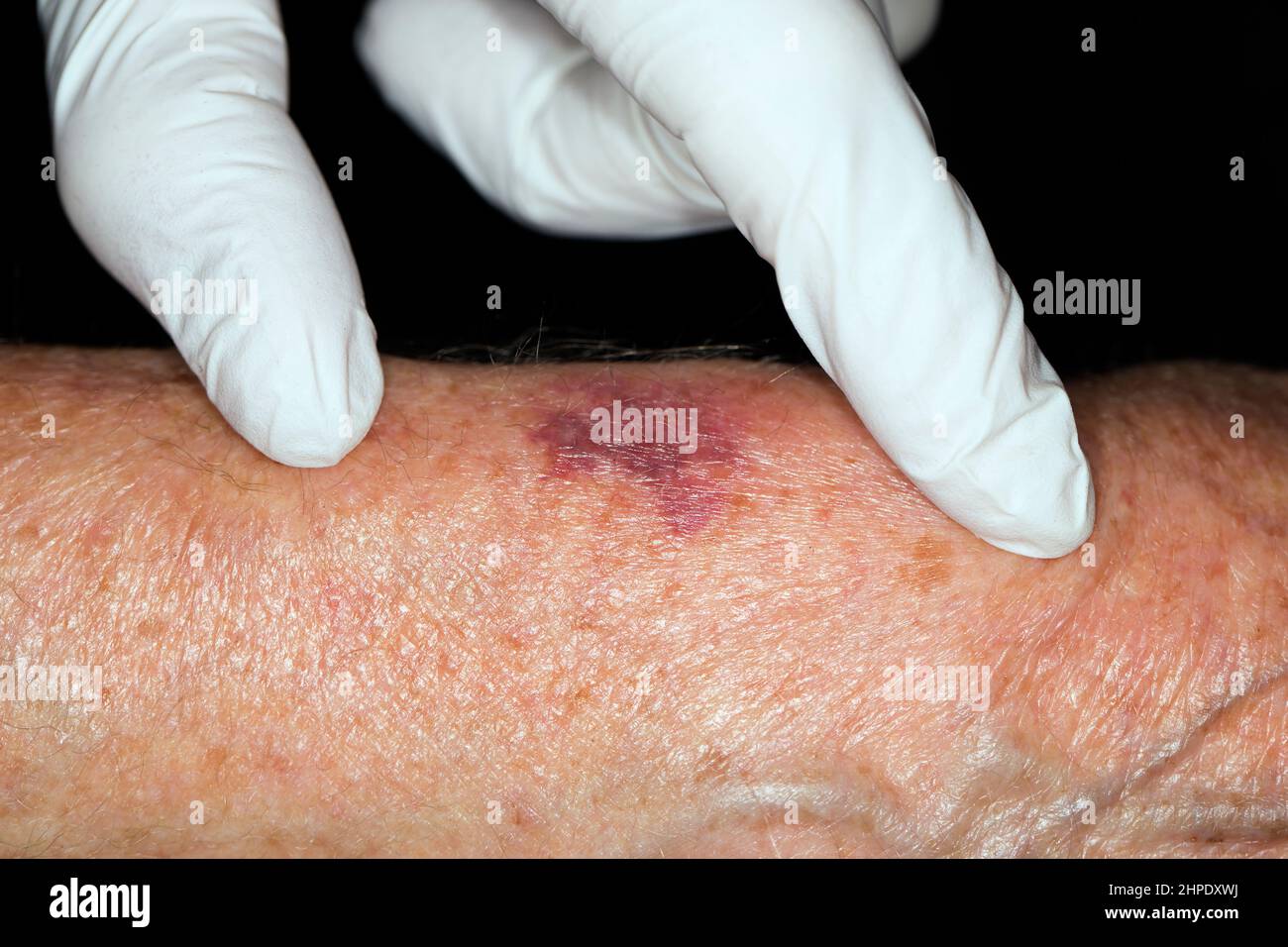 Purpura sénile Banque de photographies et d’images à haute résolution ...