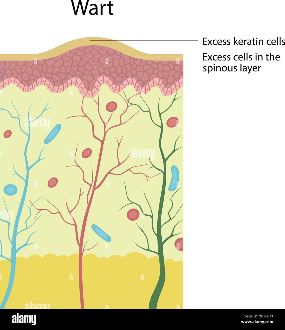 Verrugas genitales Banque d'images vectorielles - Alamy