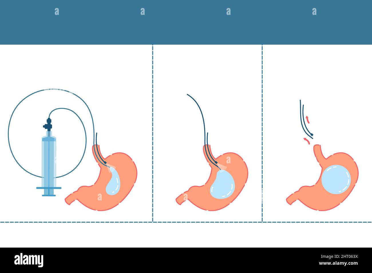 Ballon gastrique Banque de photographies et d’images à haute résolution - Alamy