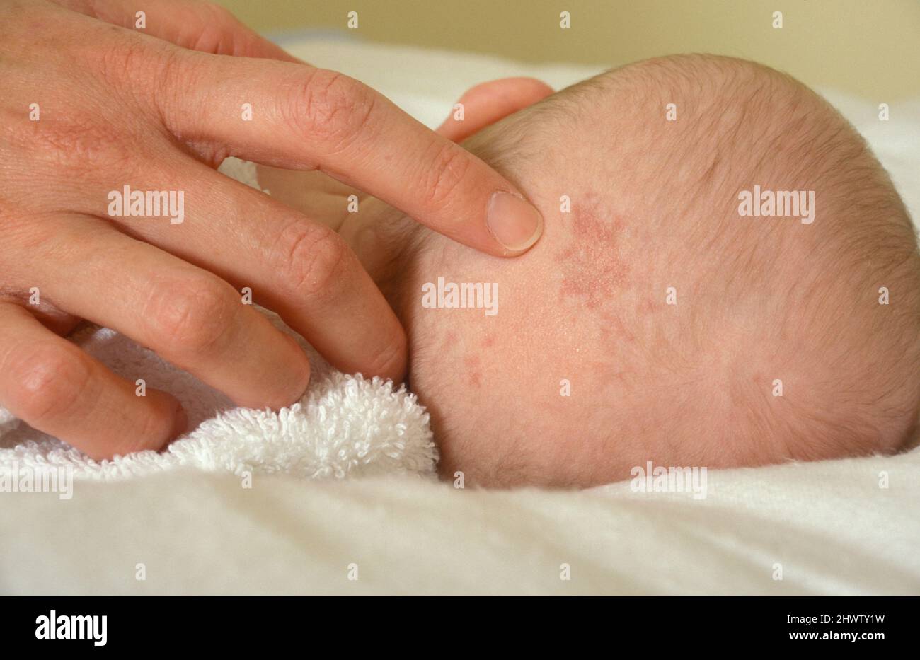 Tache de naissance Banque de photographies et d’images à haute ...