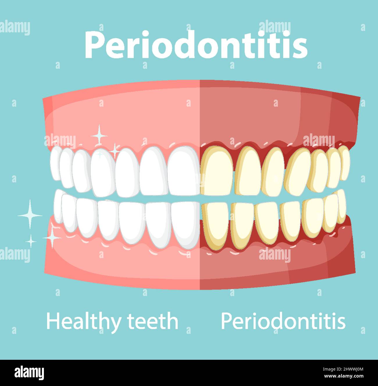 Infographie sur l'humain dans l'illustration de la parodontite Image ...