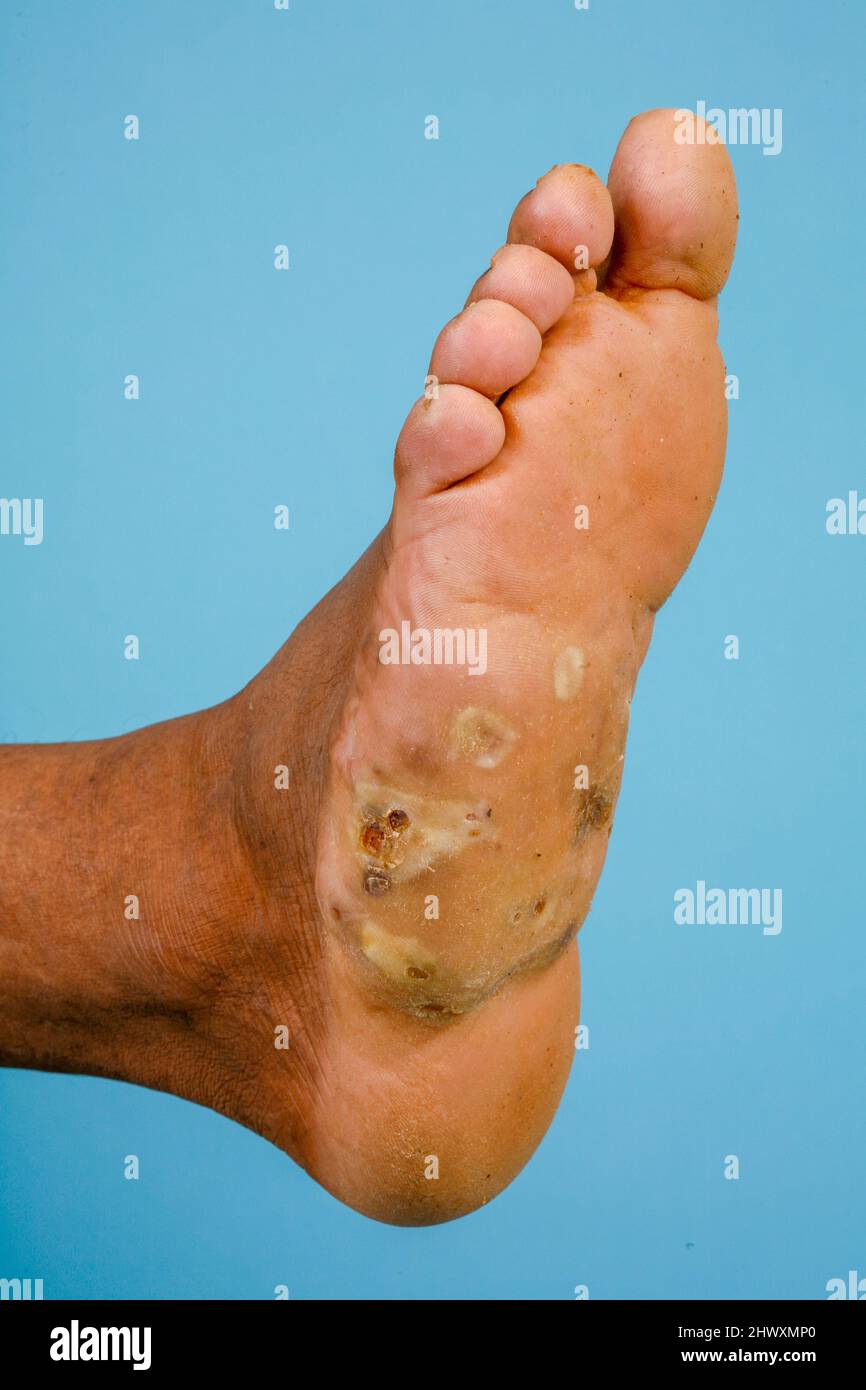 Granulome inflammatoire Banque de photographies et d’images à haute ...