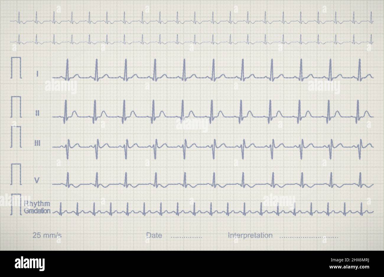 Illustration du diagramme ECG (cardiogramme) d'un patient médical Photo ...