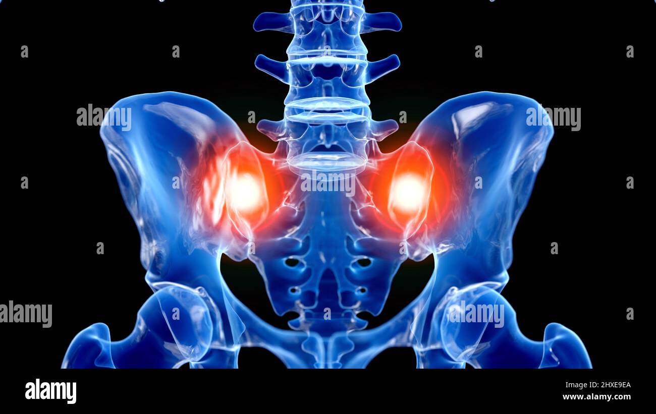 Douleur dans l'articulation sacro-iliaque, illustration Photo Stock - Alamy