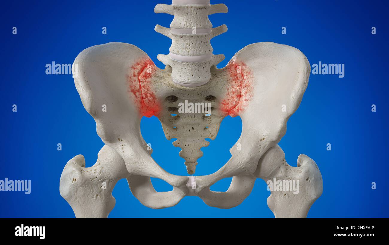 SacroIliac Dysfunction RISE BC