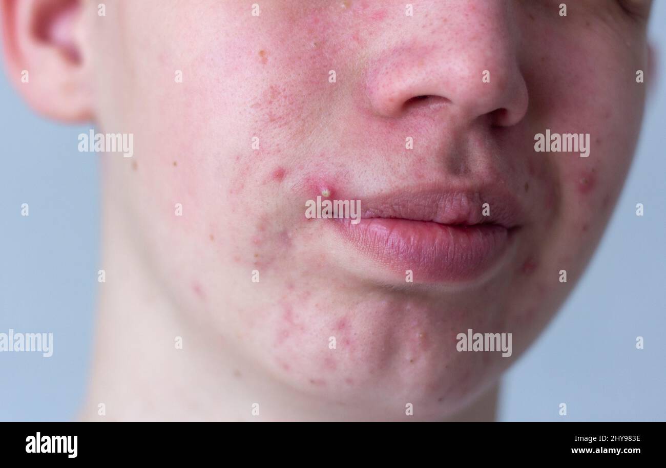 Une image de l'acné sur le visage d'un adolescent . Boutons, cicatrices ...