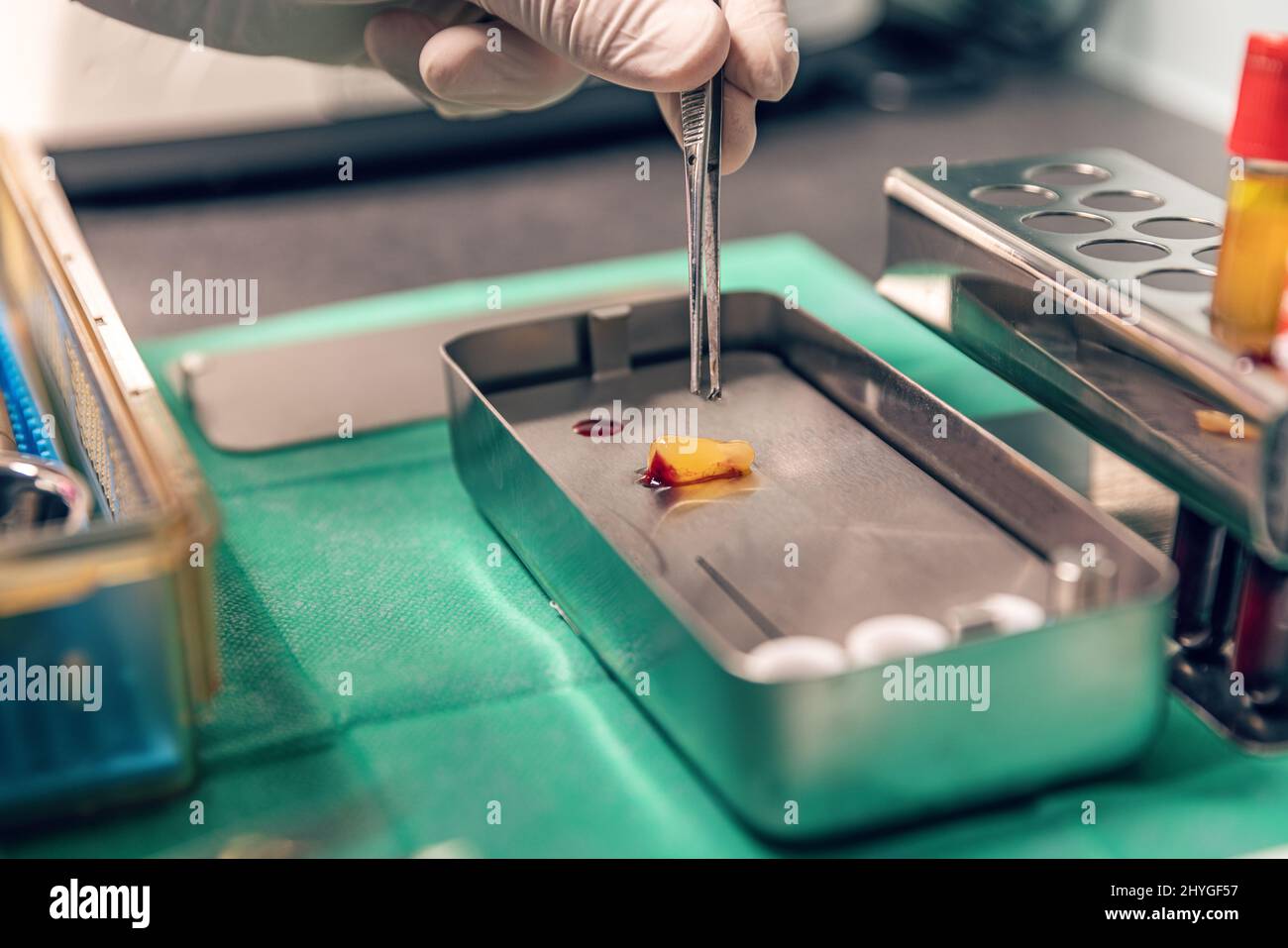 La fibrine riche en plaquettes PRF est un nouveau traitement ...