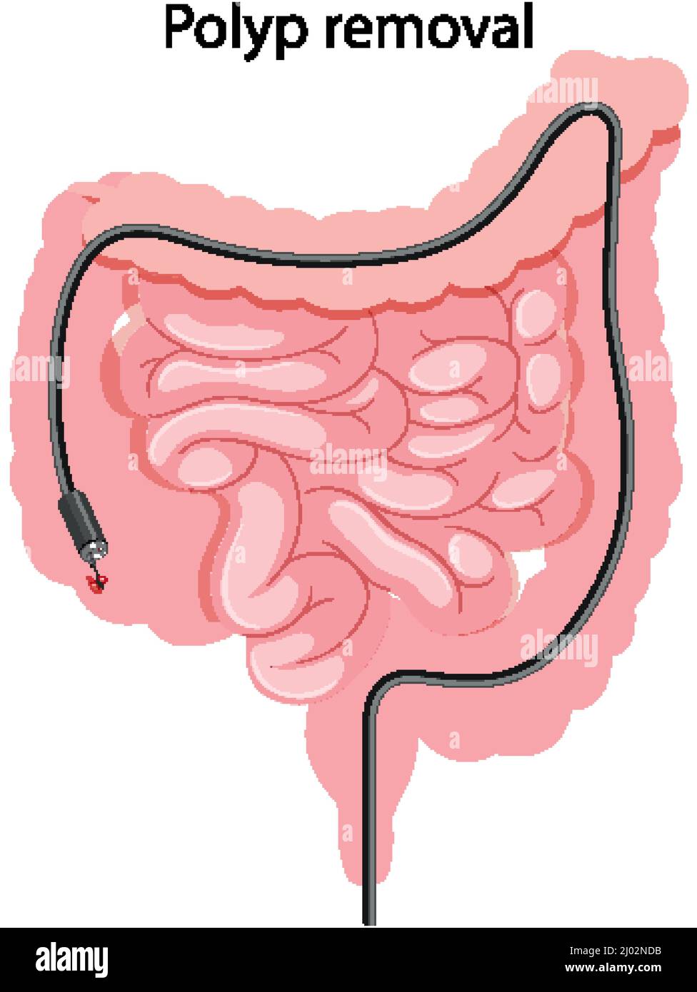 Polype du côlon humain Banque d'images détourées - Alamy