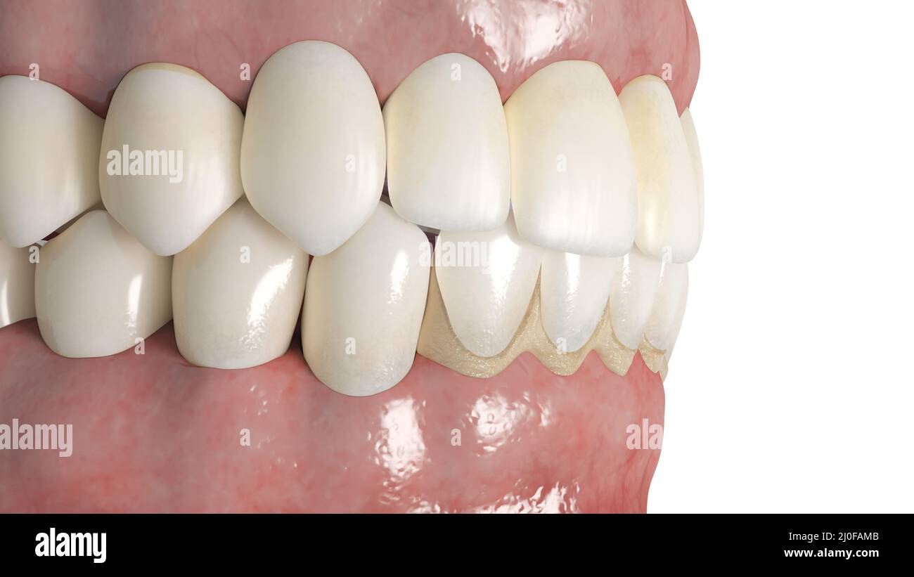 Dental calculus Banque de photographies et d’images à haute résolution ...