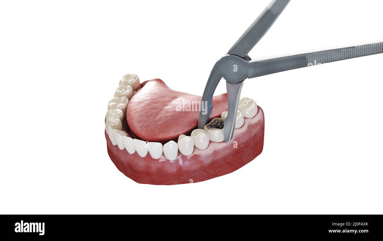 Tooth extraction Banque de photographies et d’images à haute résolution - Alamy