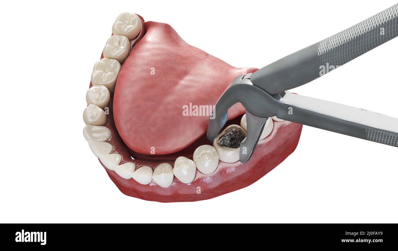 Tooth extraction Banque de photographies et d’images à haute résolution - Alamy