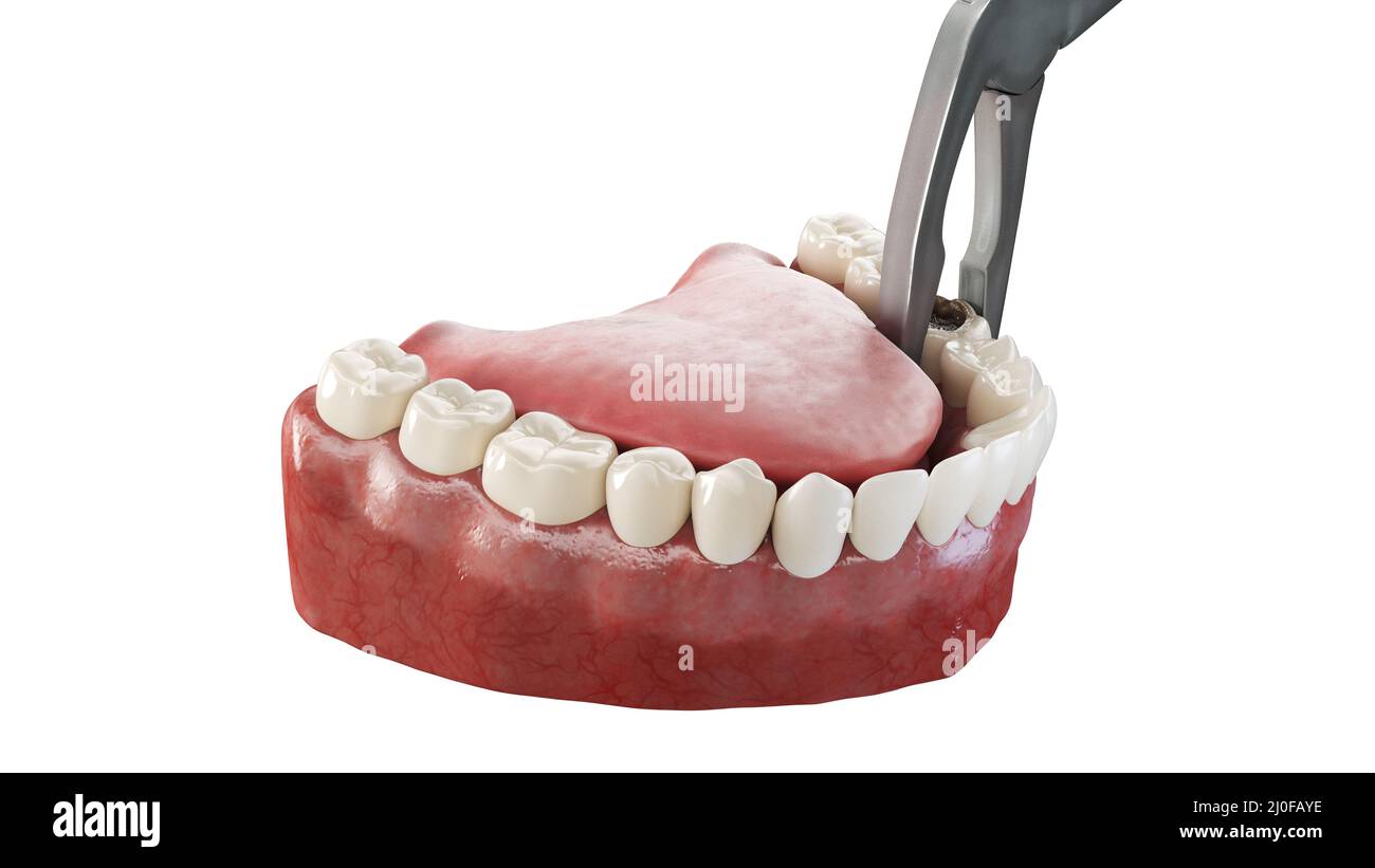 Tooth extraction Banque de photographies et d’images à haute résolution - Alamy