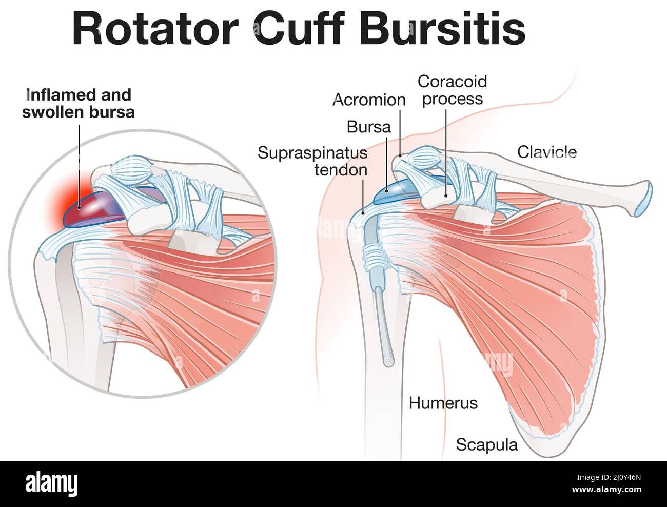 Illustration montrant la bursite de la coiffe des rotateurs Photo Stock ...