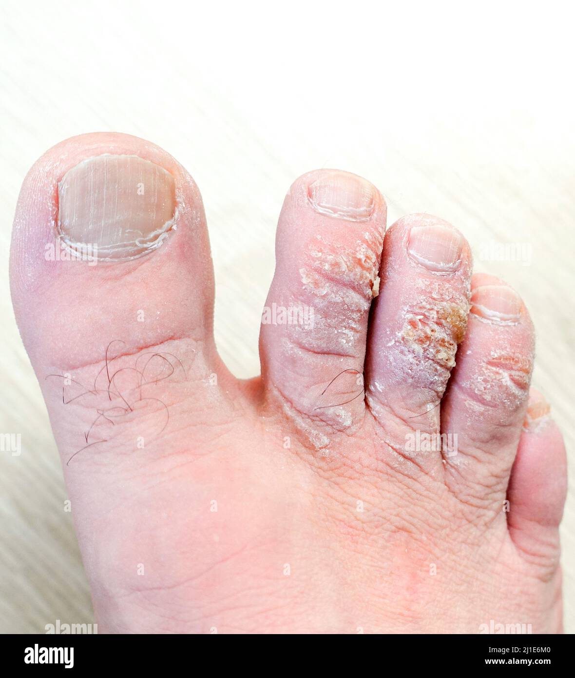 maladies de la peau des pieds, formation fongique sur les doigts ...