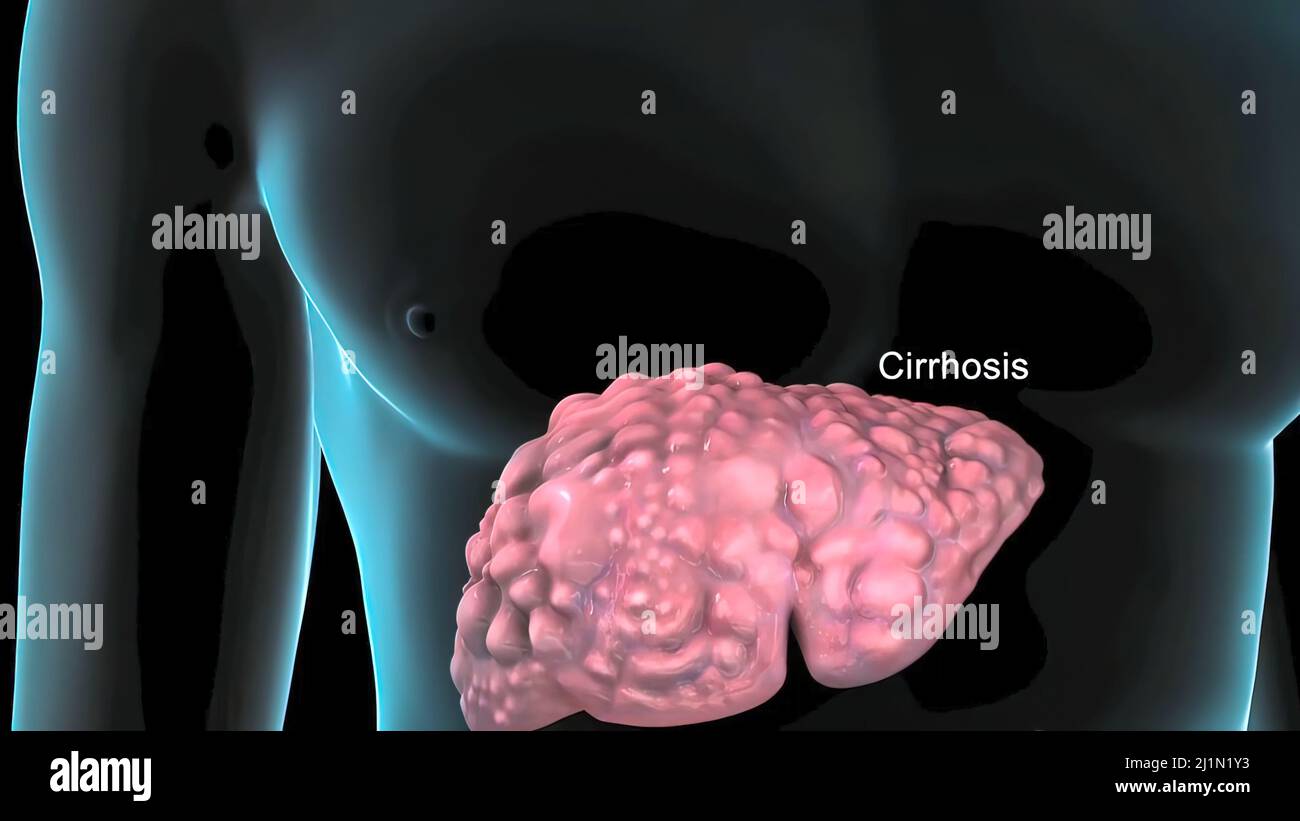 Fibrose Cardiaque Banque d'image et photos - Alamy