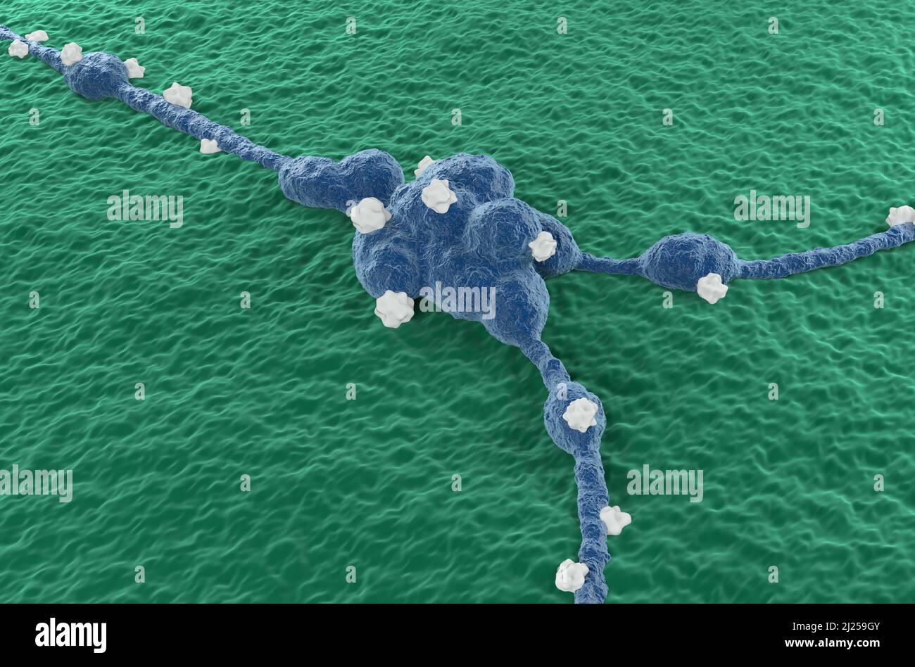Neuroblastome cellules tumorales dans le système nerveux central ...