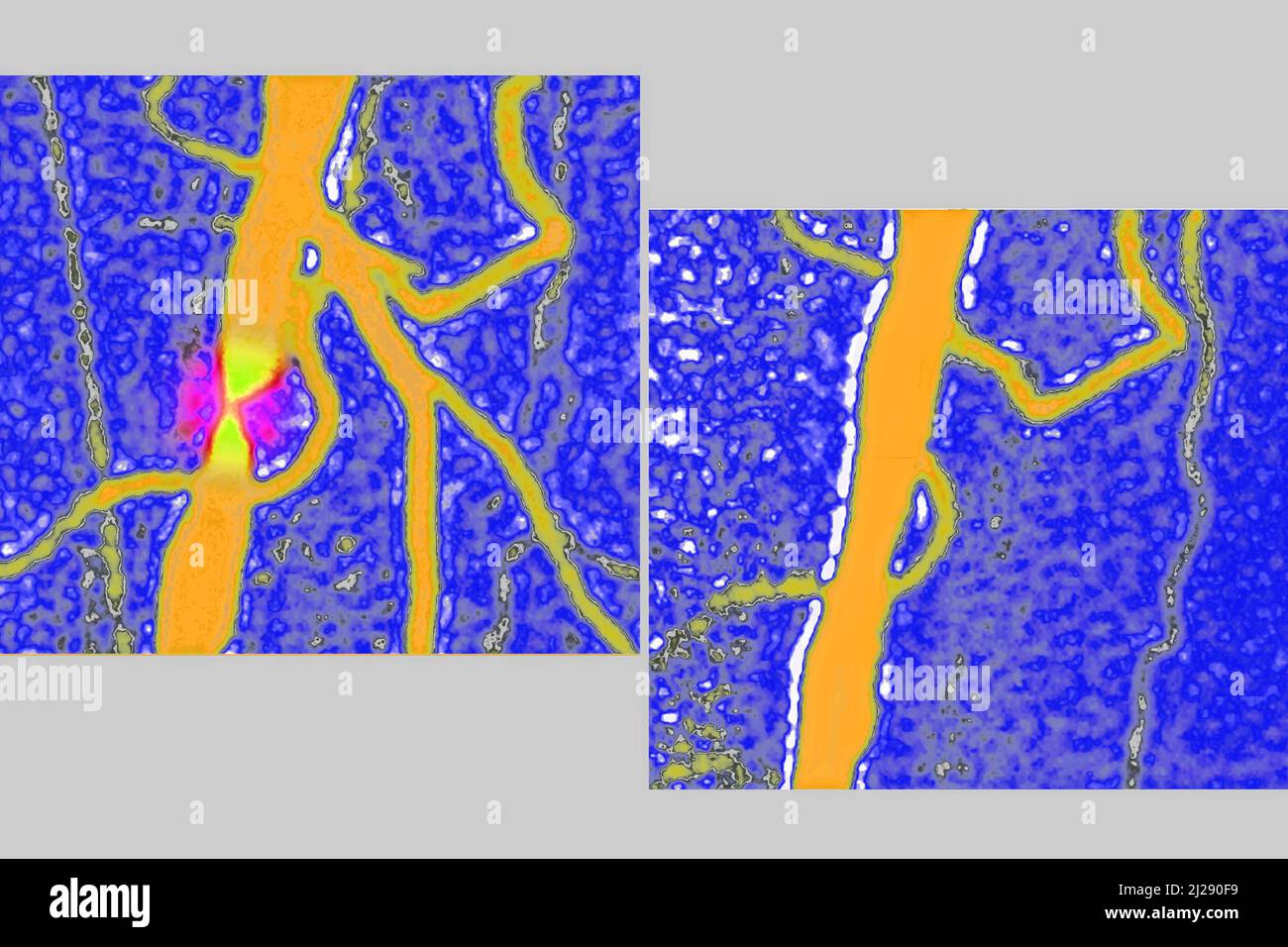 Vaisseaux sanguins iliaques Banque de photographies et d’images à haute ...