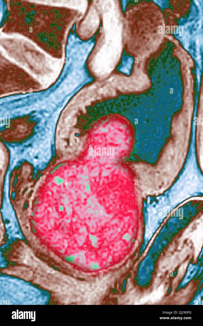 Prostate et vessie Banque de photographies et d’images à haute ...