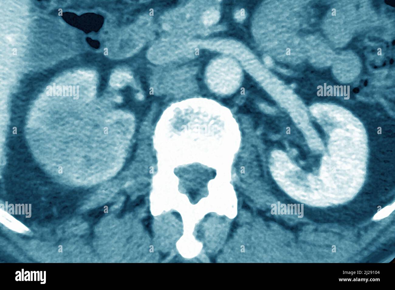 Cancer de la tumeur Banque de photographies et d’images à haute résolution - Page 8 - Alamy