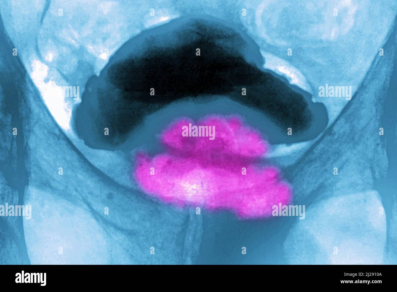 Cancer de la prostate Banque de photographies et d’images à haute résolution - Alamy