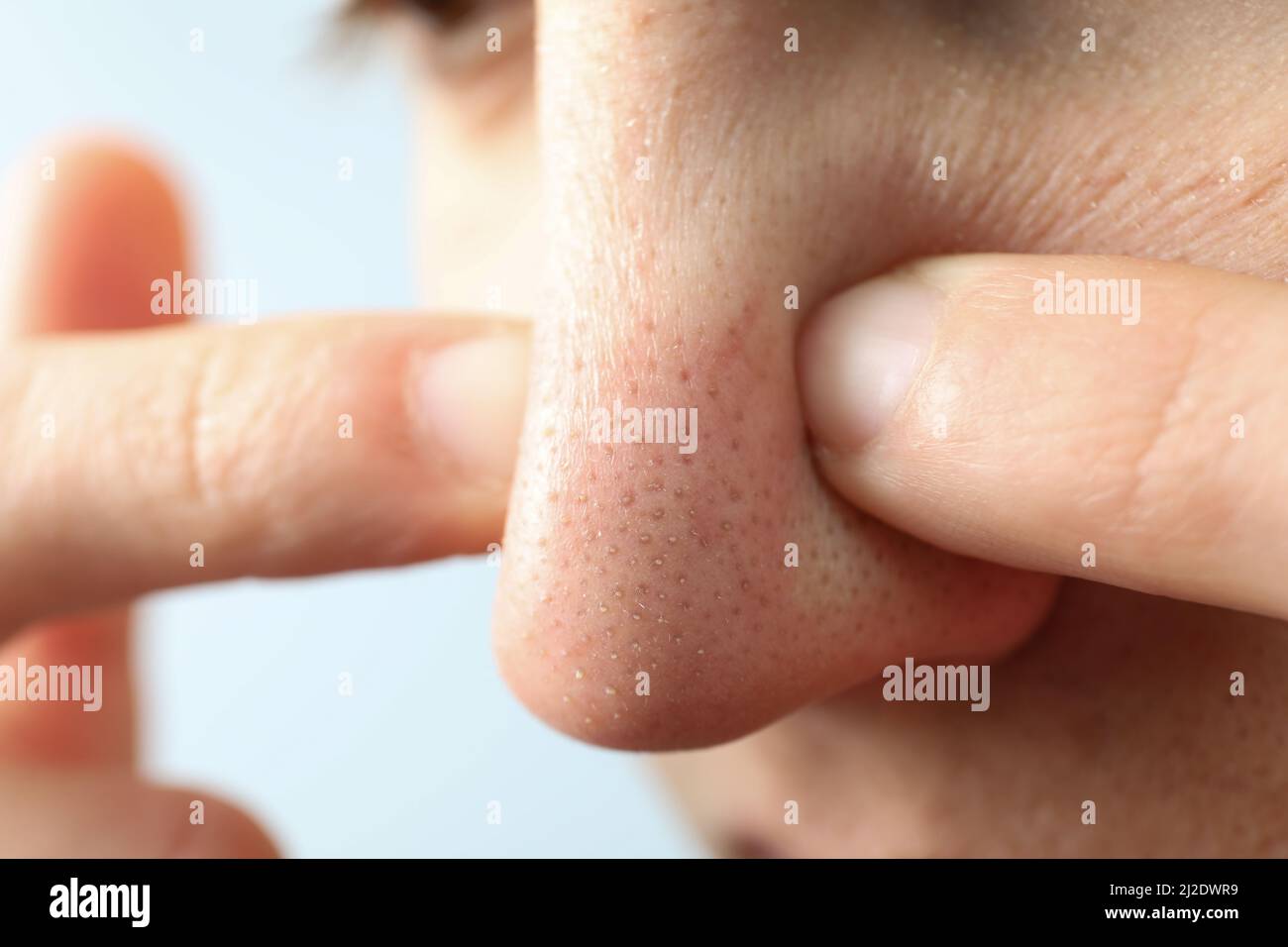 Cancer de la peau,carcinome nez Banque de photographies et d’images à ...