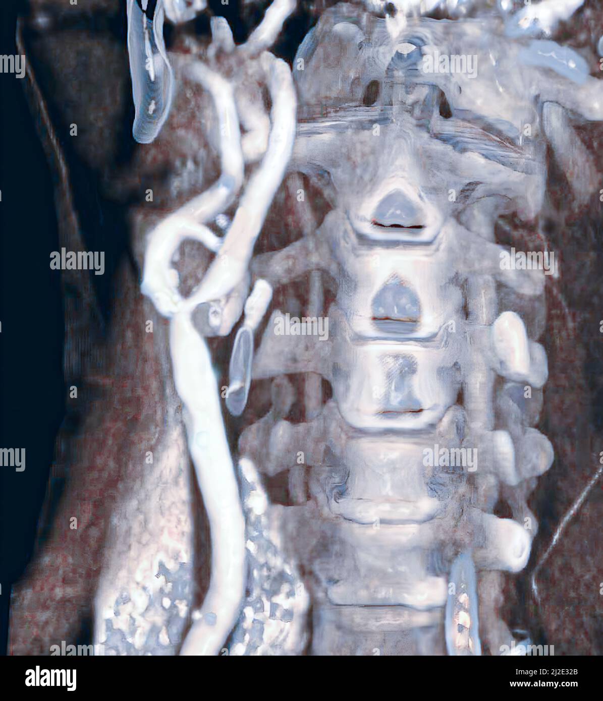 La carotide anatomie Banque de photographies et d’images à haute ...