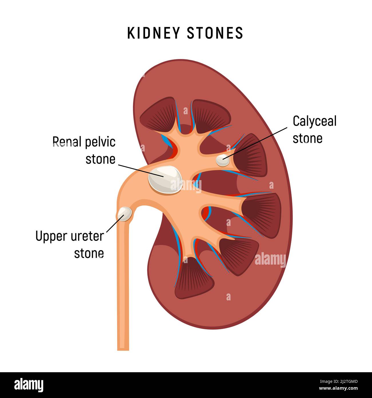 Infographie sur le vecteur de la maladie des calculs rénaux. Urine ...