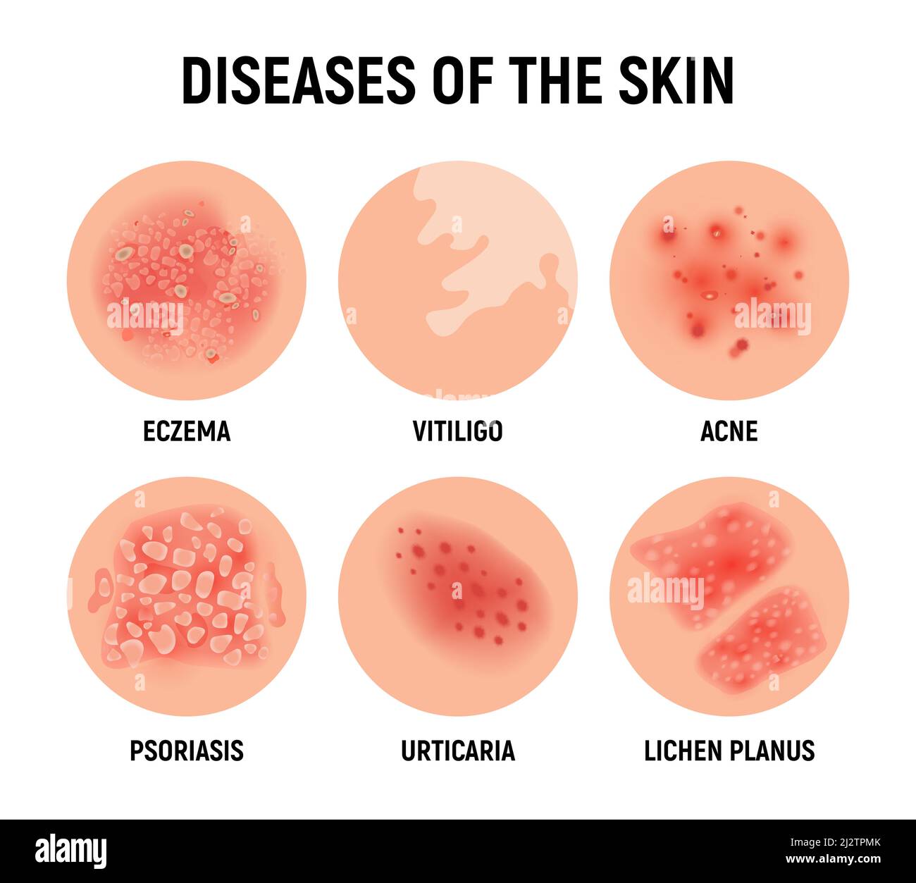 Psoriasis éruption cutanée vecteur peau infection des mains. Schéma de ...