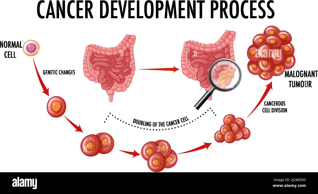 Comment Appelle-T-On Un Cancer Qui Prend Naissance Dans Une Cellule ...