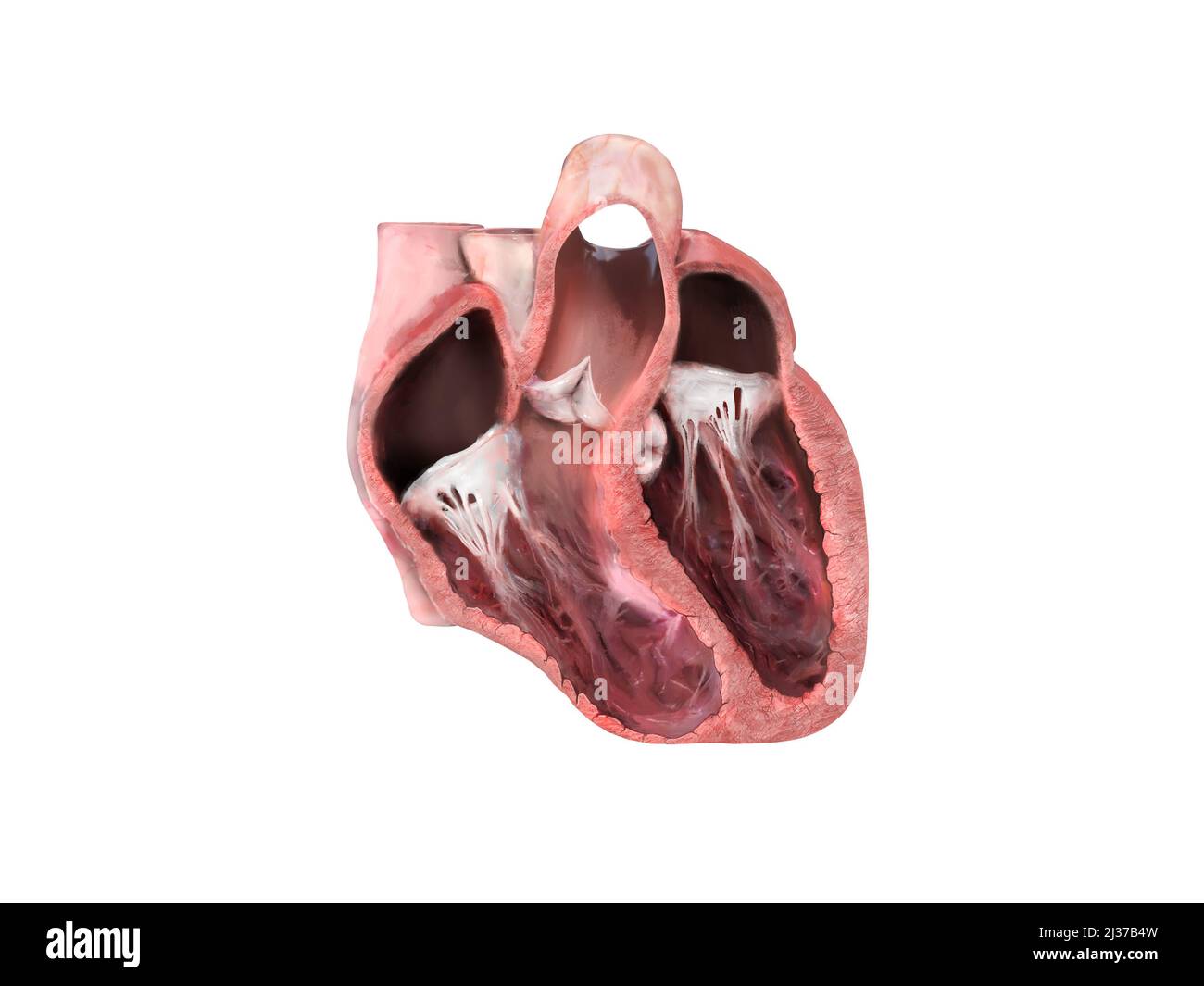 Anatomie cardiaque, anévrisme ventriculaire gauche, renflement de la ...