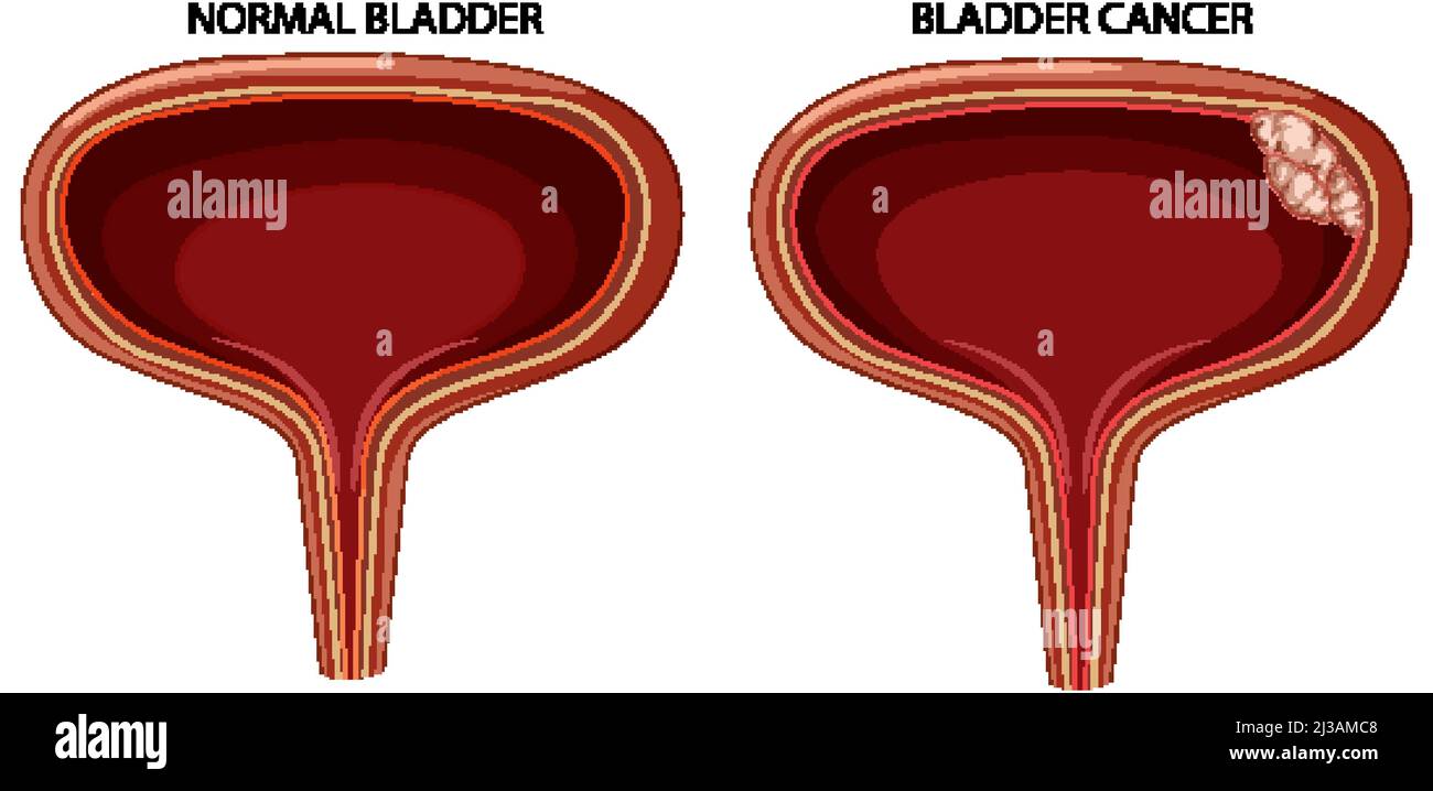 Tumeur de la vessie Banque d'images vectorielles - Alamy