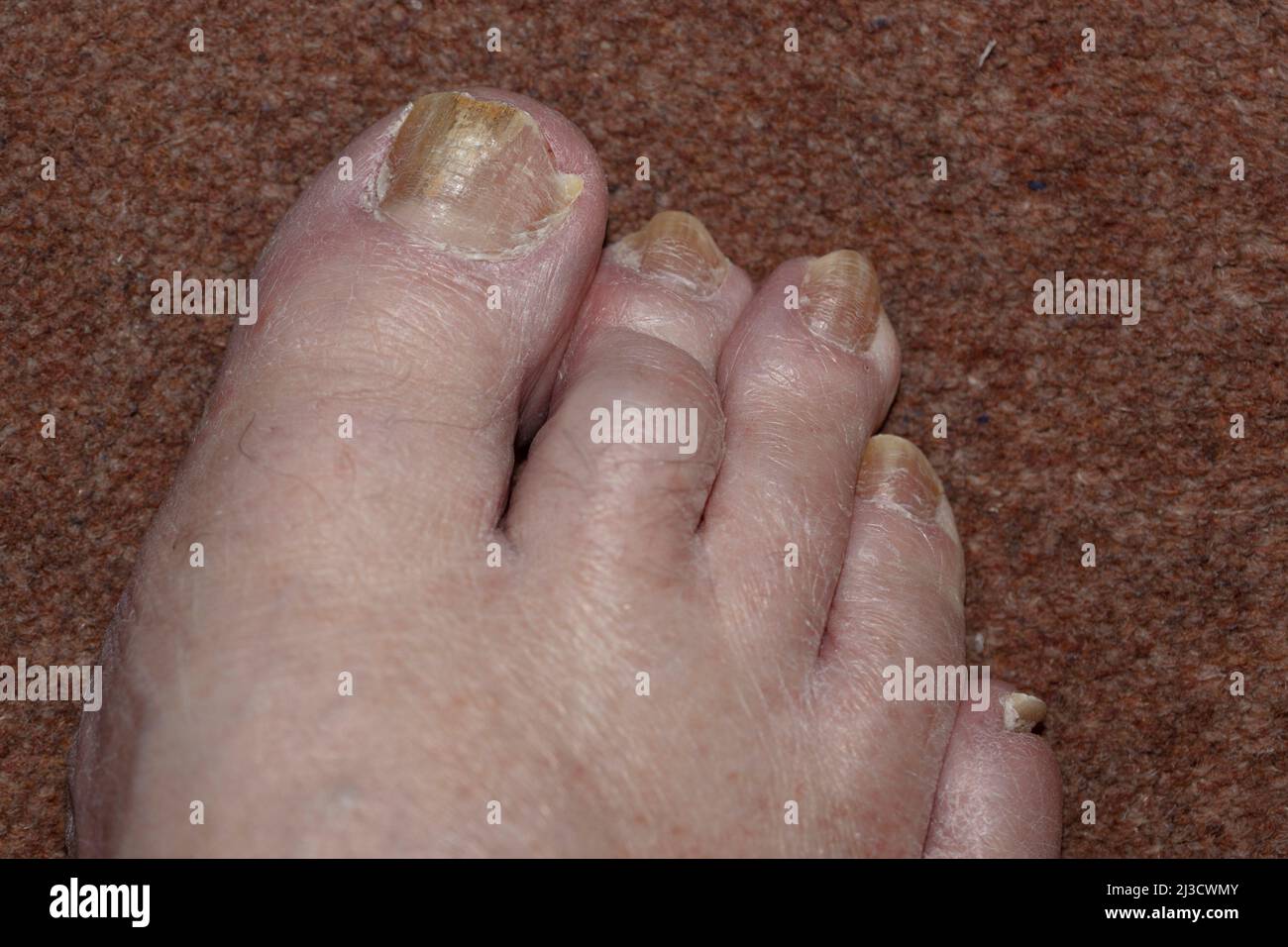 Infection fongique de ongles Photo Stock - Alamy