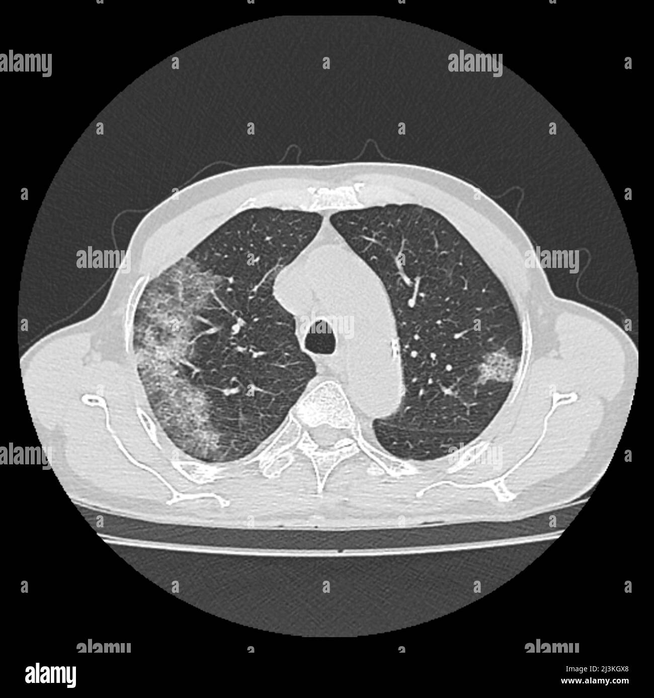 Thorax ct virus corona Banque de photographies et d’images à haute ...